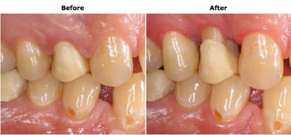 Examples of Before and After - Berenguer Periodontics – Periodontics ...